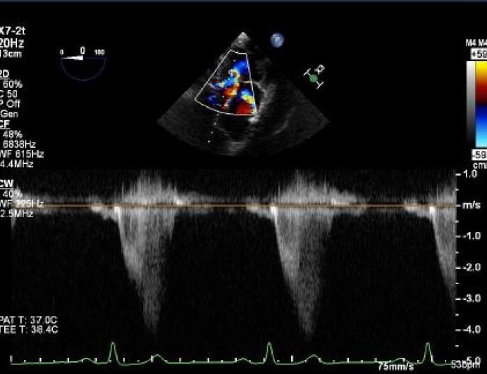 Echo Contrast Cases - EtOHSeptal Ablation | tctmd.com